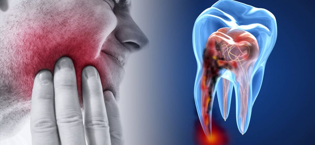 Devitalization – Global Dental Albania